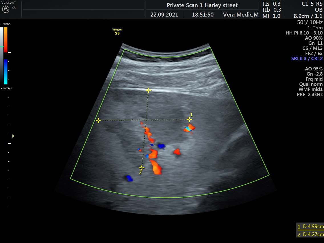 LIVER SCAN | Private Ultrasound Scans London