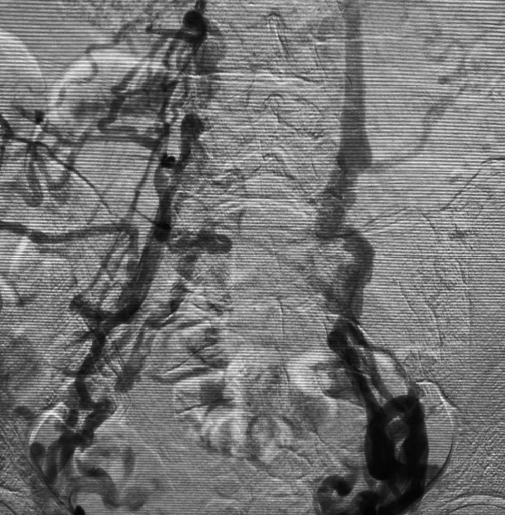 DVT Scan (Deep Vein Thrombosis) | Private Ultrasound Scans London