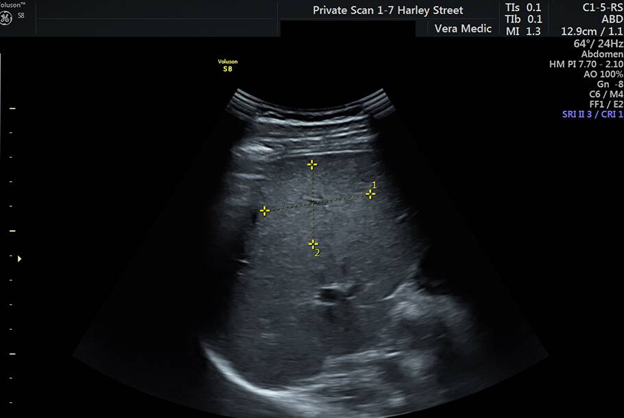 Liver Scan Man | Private Ultrasound Scans London