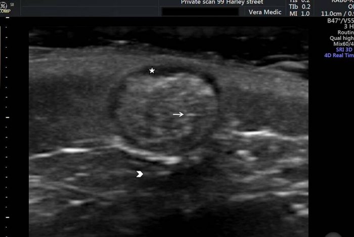 Lumps and Bumps Scan | Private Ultrasound Scans London