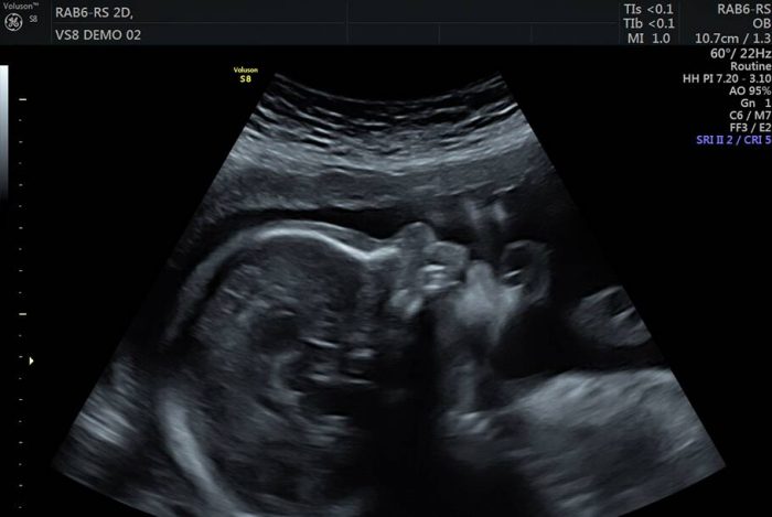Reassurance Baby Scan | Private Ultrasound Scans London