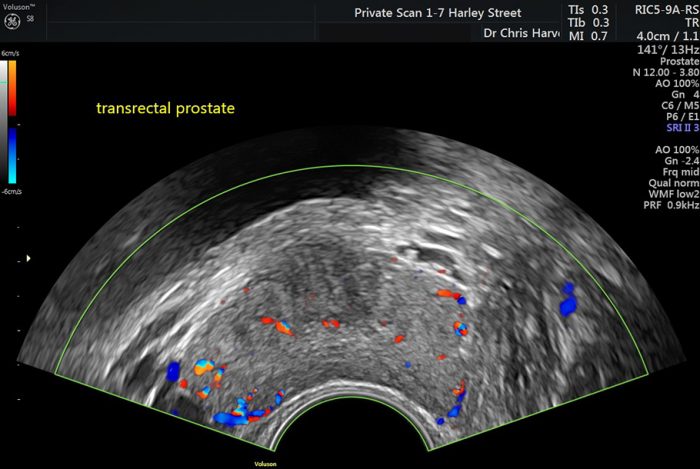 Prostate Ultrasound Scan (Transrectal) | Private Ultrasound Scans London