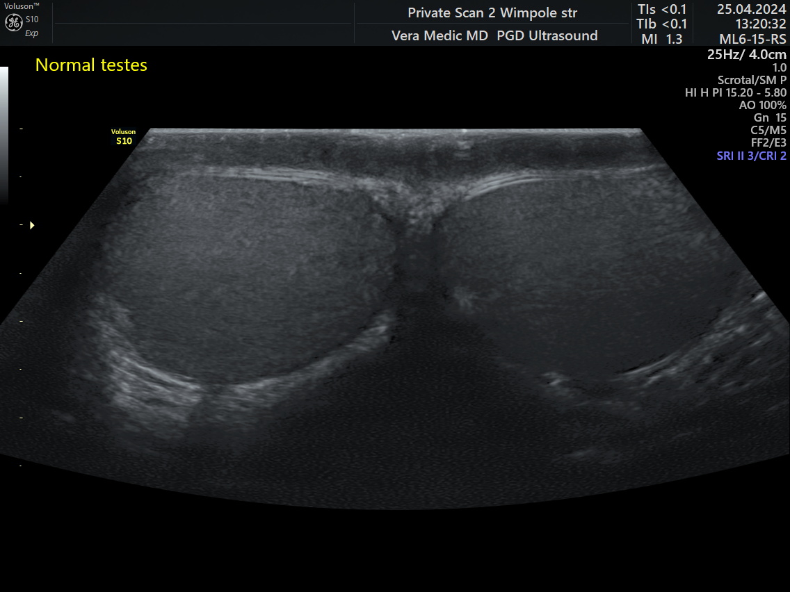 Testicular Cancer: Understanding, Awareness and Ultrasound